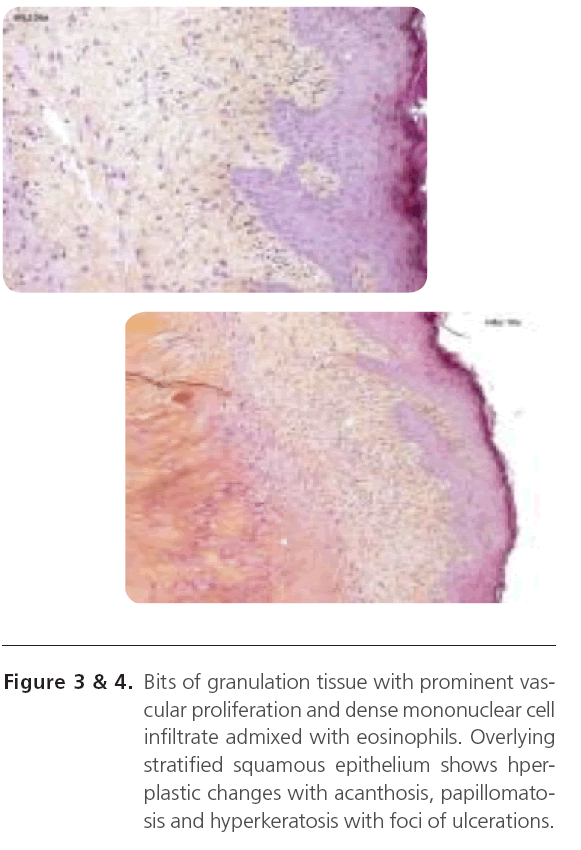 An Unusual Case Of Winkler s Disease Of Pinna